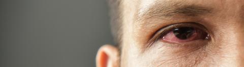 What Causes Dry Eyes?