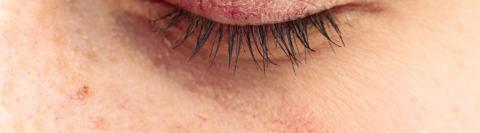 Blepharitis symptoms and treatment
